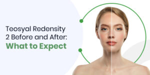 Teosyal Redensity 2 Before and After: What to Expect - MedEuroStore